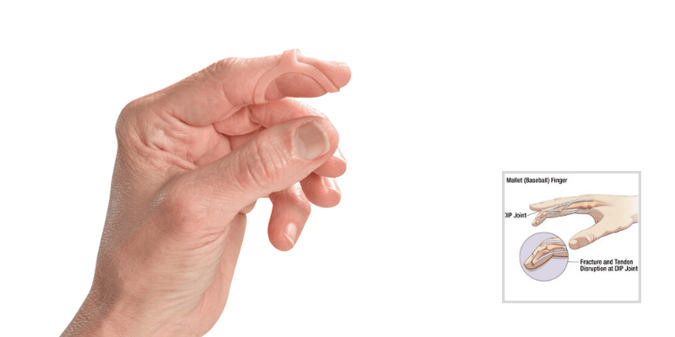 Treating Trigger Thumb with an Oval-8 Finger Splint - Updated 2023 Treating Trigger Thumb with an Oval-8 Finger Splint - Updated 2023